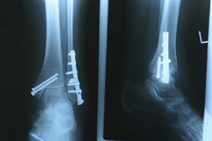 Types of Ankle Fractures